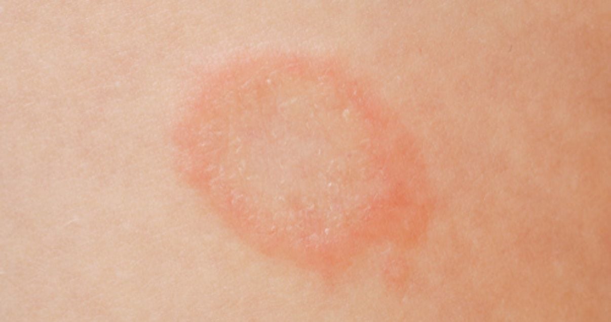 Ringworm Causes Why Do I Keep Getting Ringworm Ringworm Causes Why Do I Keep Getting Ringworm